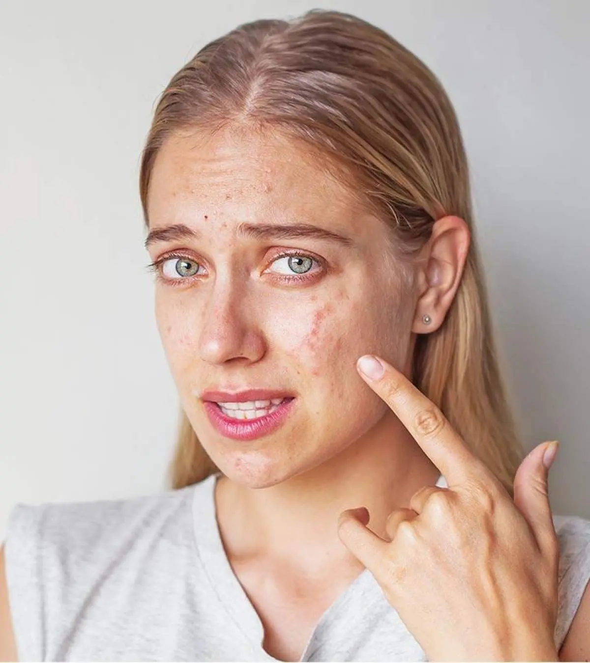 How To Remove Acne Scars: 14 Natural Remedies That Work