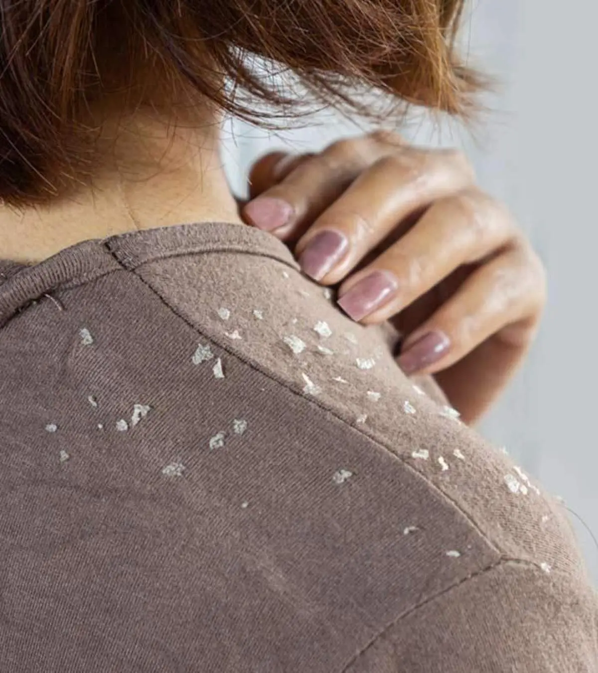 5 Easy DIY Hair Masks To Fight Winter Dandruff
