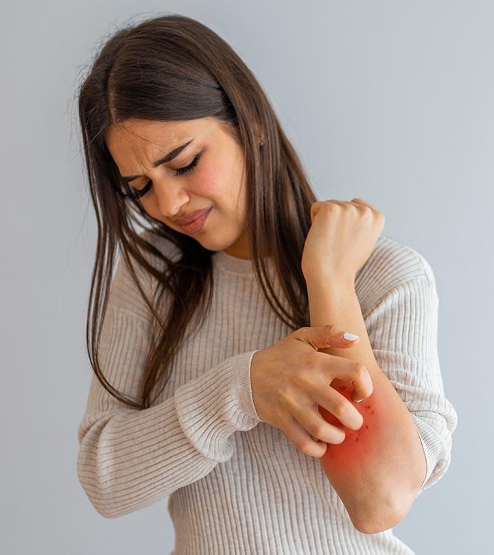 Effective Ways To Get Rid Of Hives 51 Off