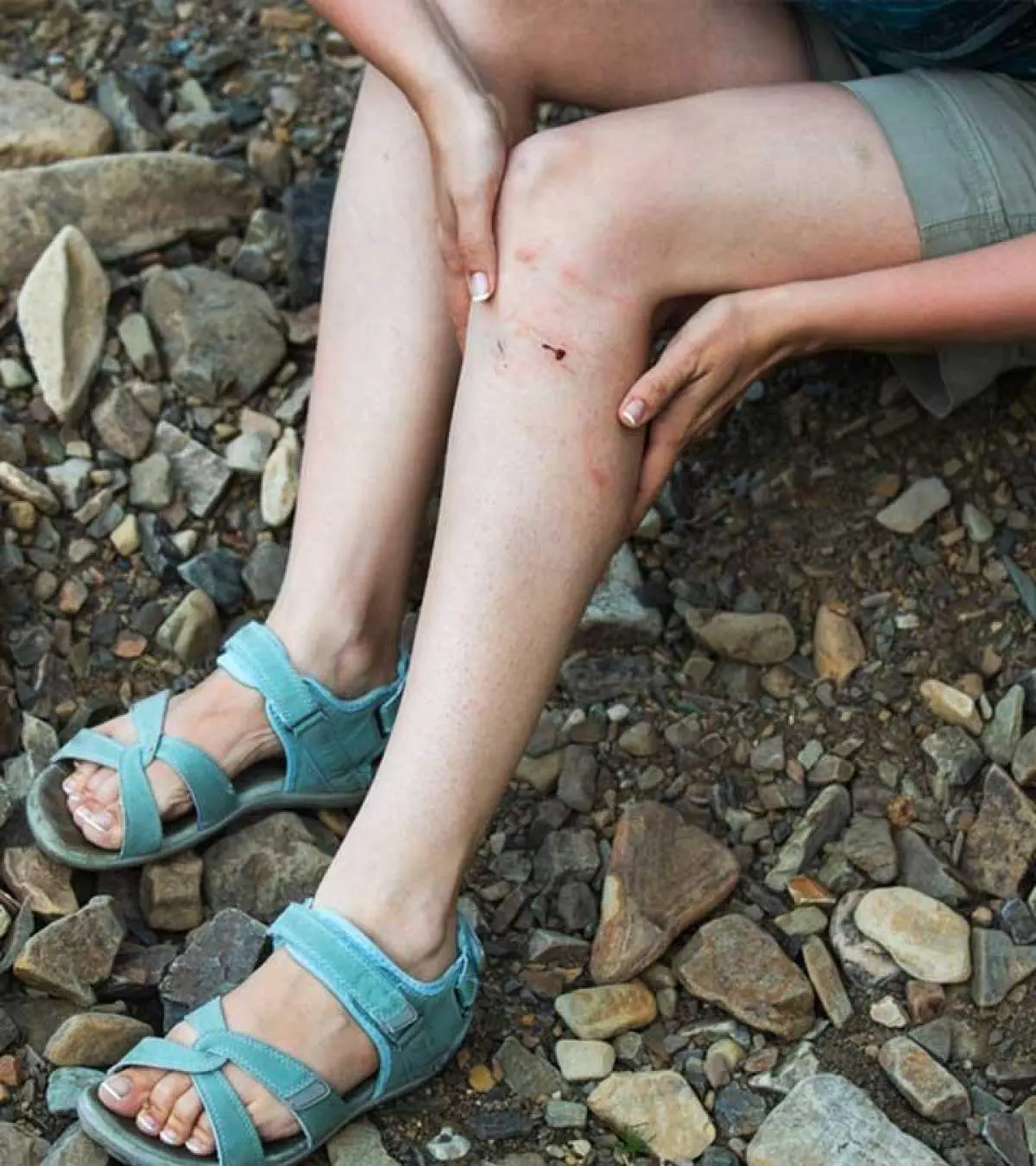 13 Home Remedies To Treat A Leg Ulcer Effectively