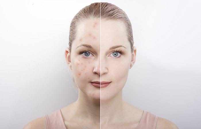 8 Amazing Benefits Of Alpha Hydroxy Acid For Your Skin