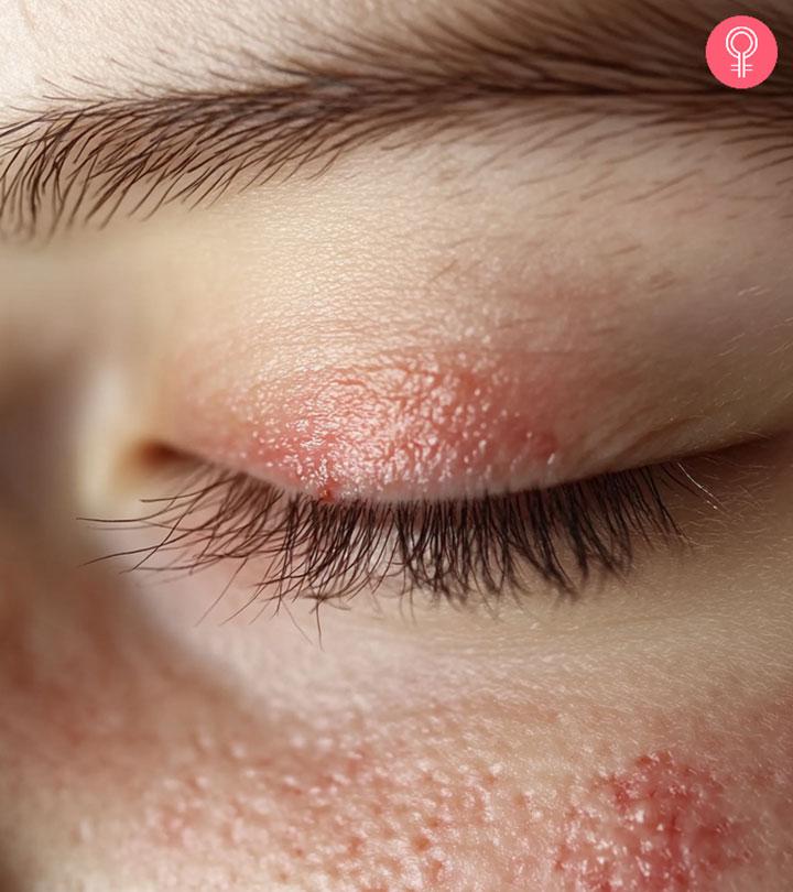 12 Home Remedies To Get Rid Of A Rash Around The Eyes