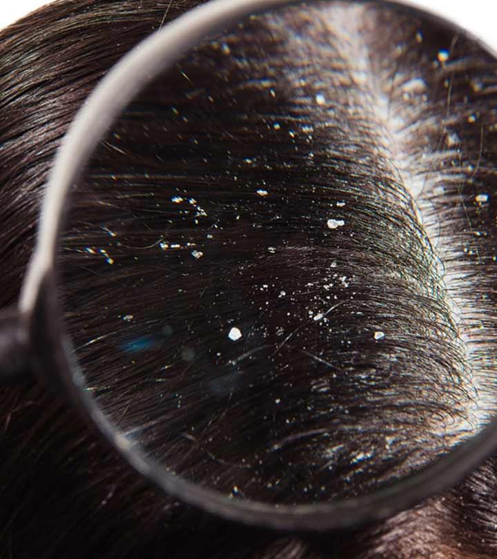 Dandruff Vs Dry Scalp Symptoms Differences And Treatment