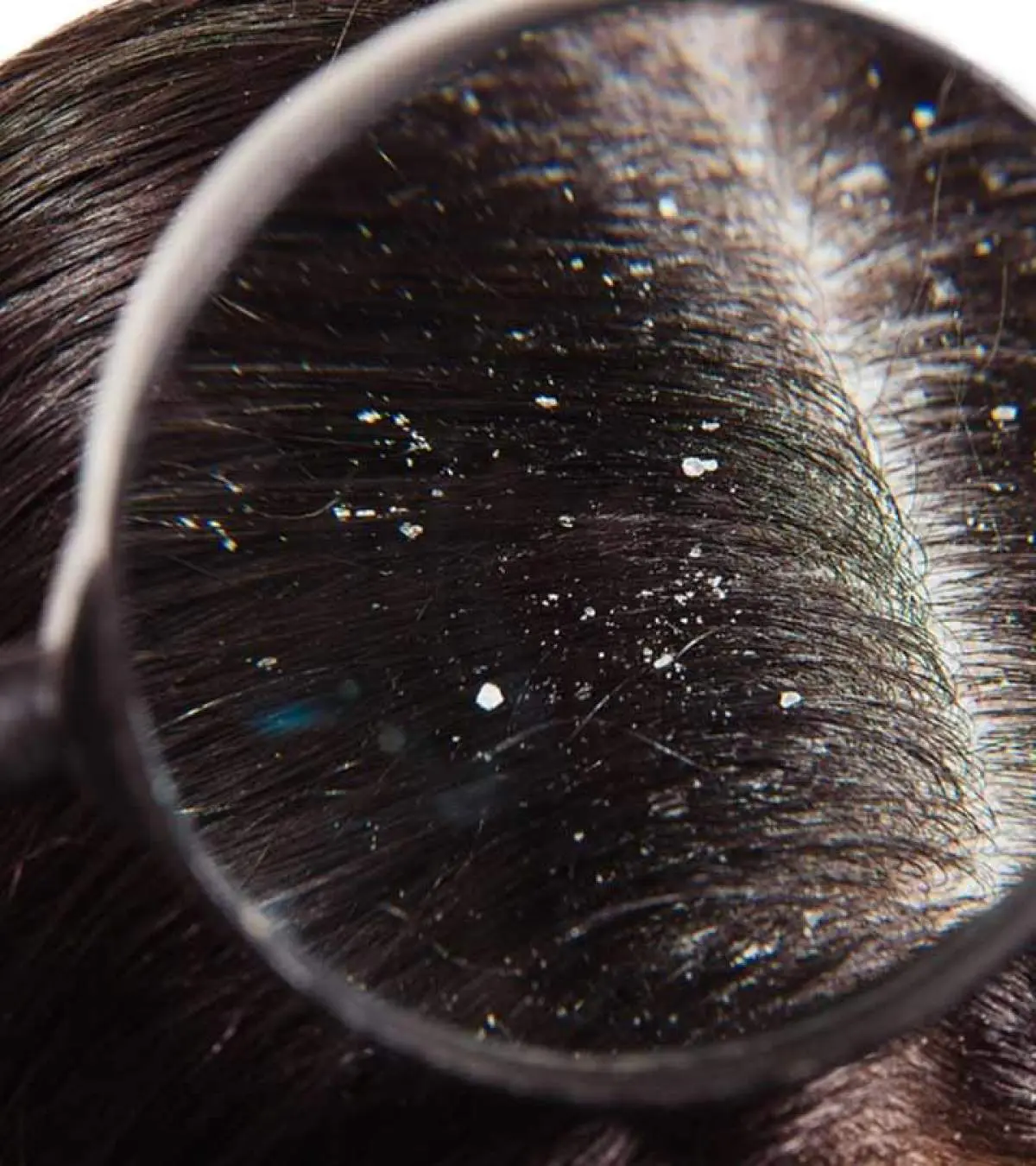 Dandruff Vs Dry Scalp: 7 Key Differences & Solutions
