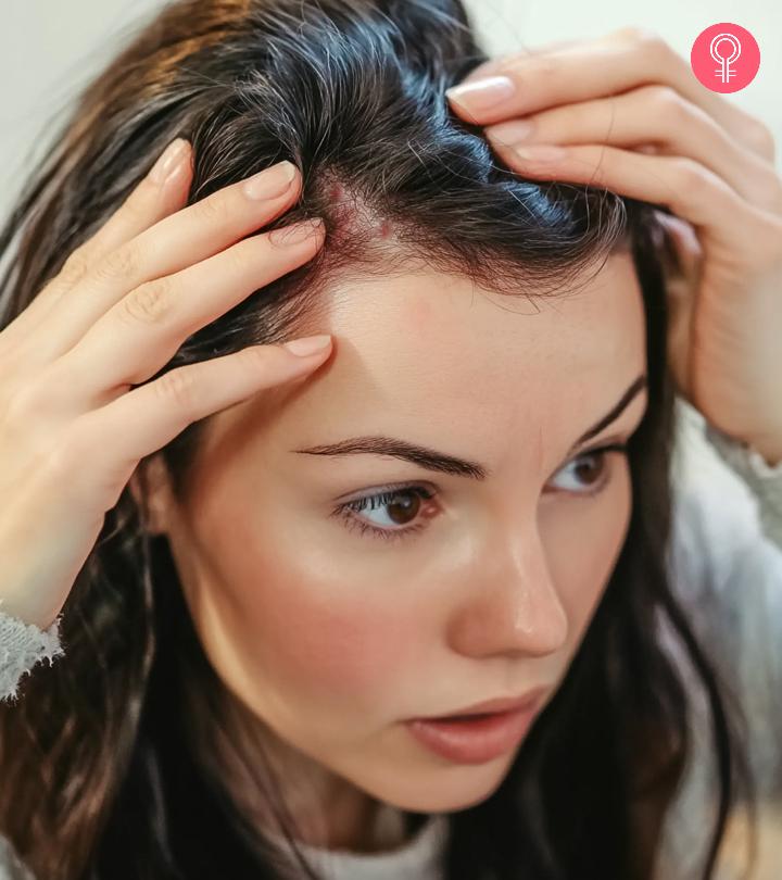 How To Treat Scabs On The Scalp