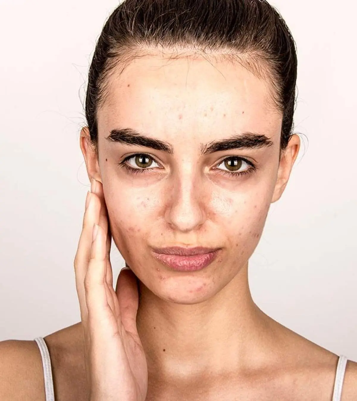 Acne Face Map: 6 Zone-Specific Causes & Prevention Tips