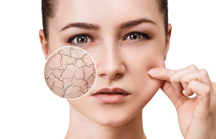 Dehydrated Skin: Causes, Symptoms, And How To Care For It
