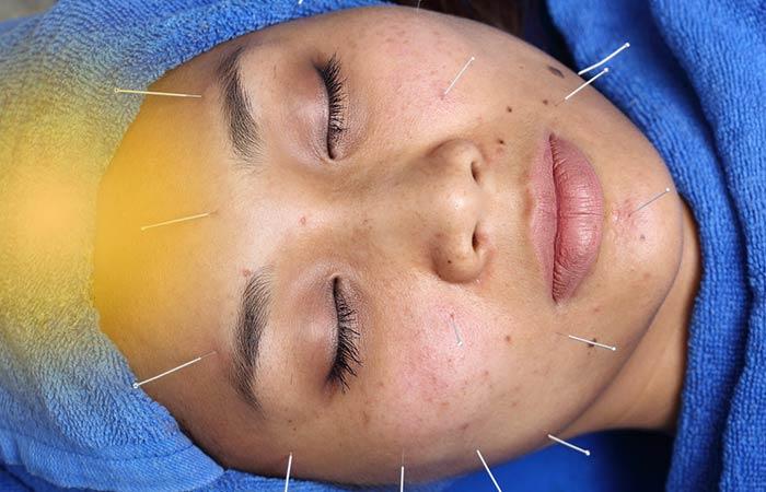 Facial Acupuncture: Benefits, How It Works, & Side Effects