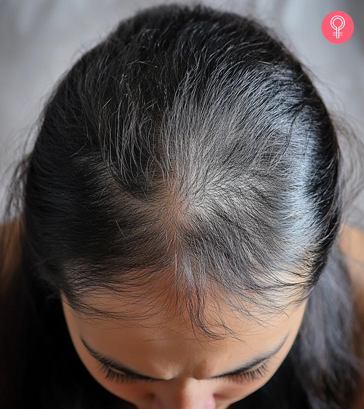 Diffuse Hair Loss (Alopecia): Causes, Signs, And Treatments