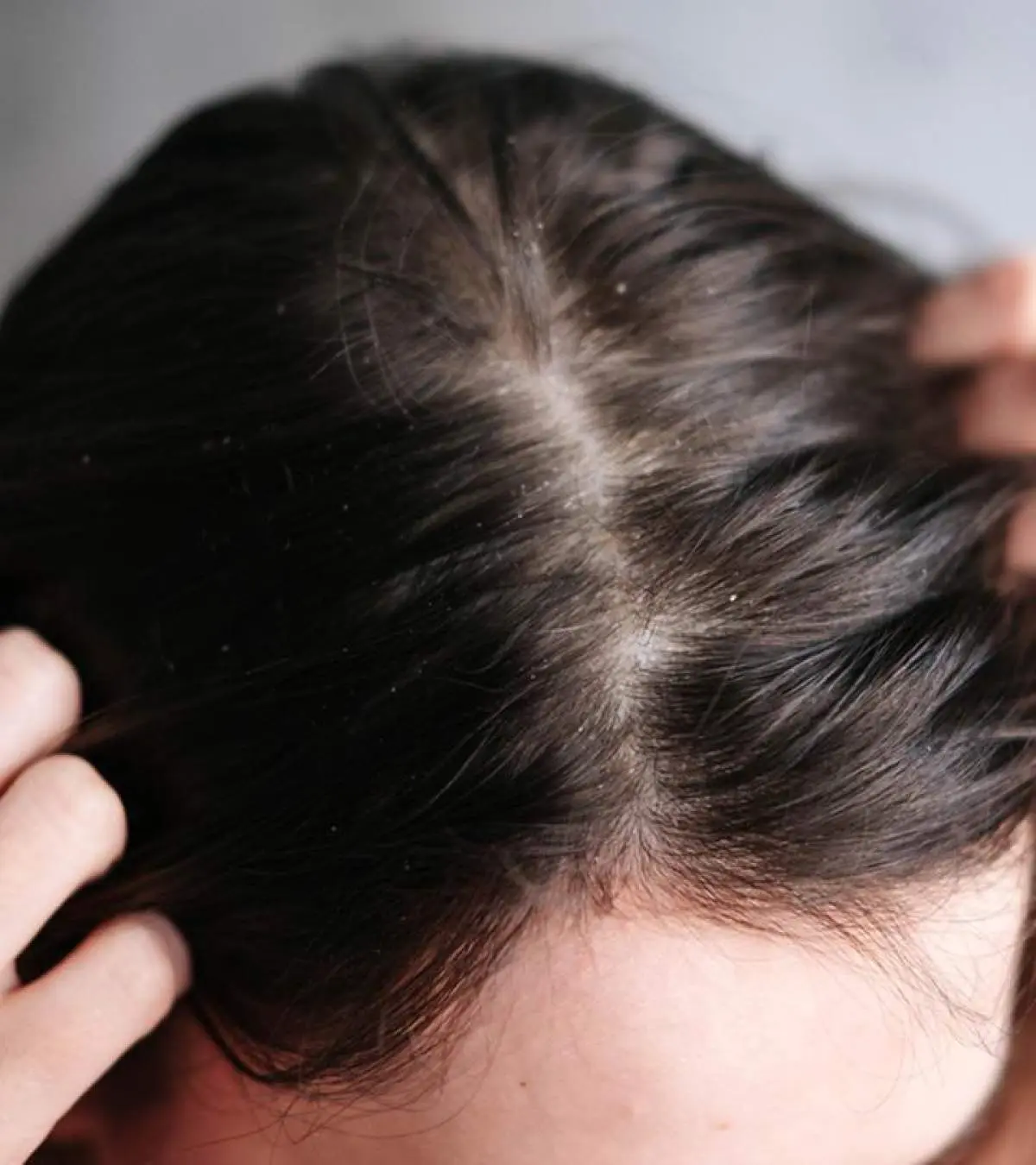 Scalp Buildup: 6 Easy Steps To Remove And Prevent It