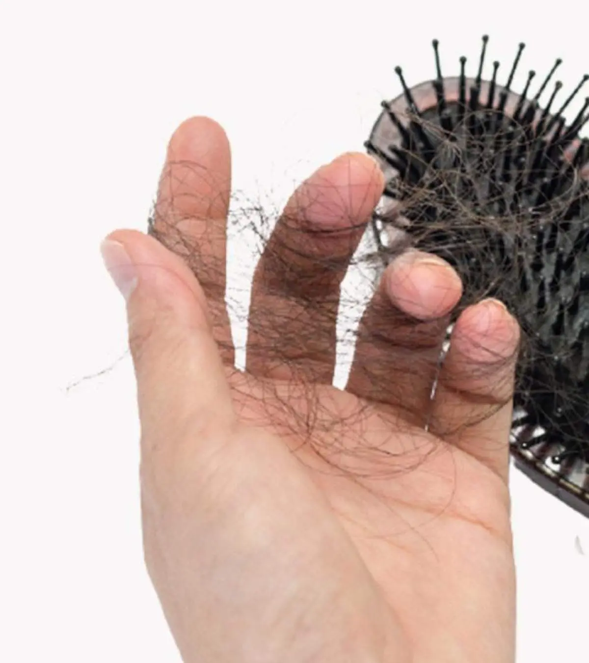 Ophiasis Alopecia: 4 Effective Treatments To Try In 2025