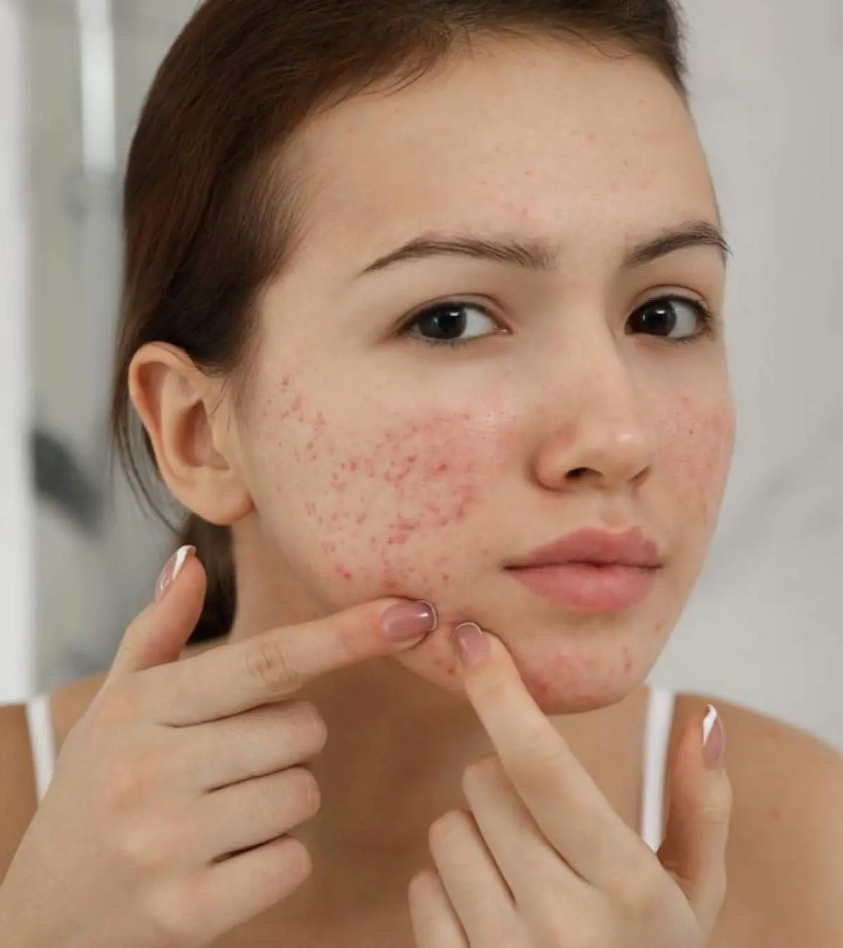 Vitamin D For Acne: 3 Key Benefits And How To Use It