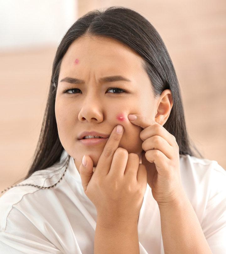 Period Acne: Symptoms, Topical & Oral Remedies, & Prevention