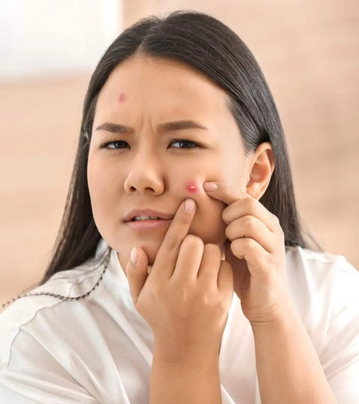 Period Acne: Causes, Symptoms, And Expert Remedies