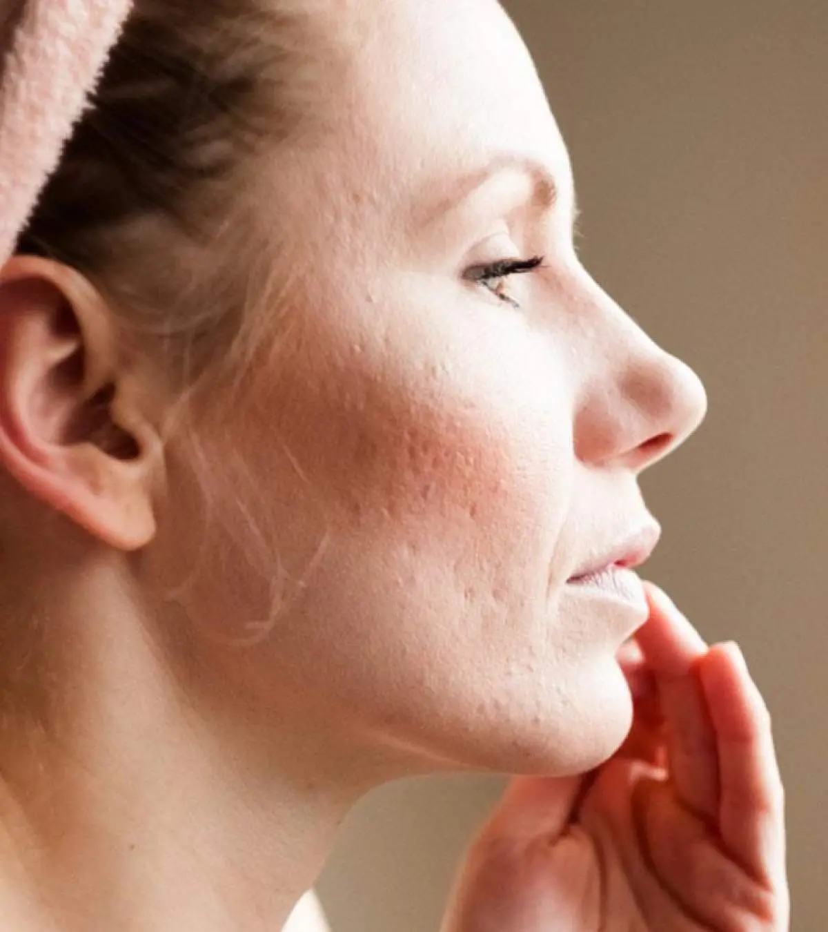 Boxcar Scars: 12 Best Treatments To Minimize Appearance