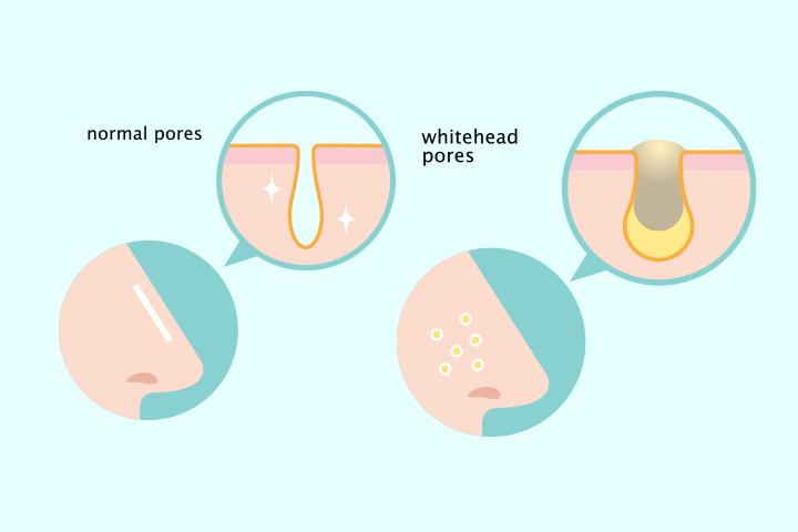 Whiteheads On Nose: Causes, Treatments, And Prevention