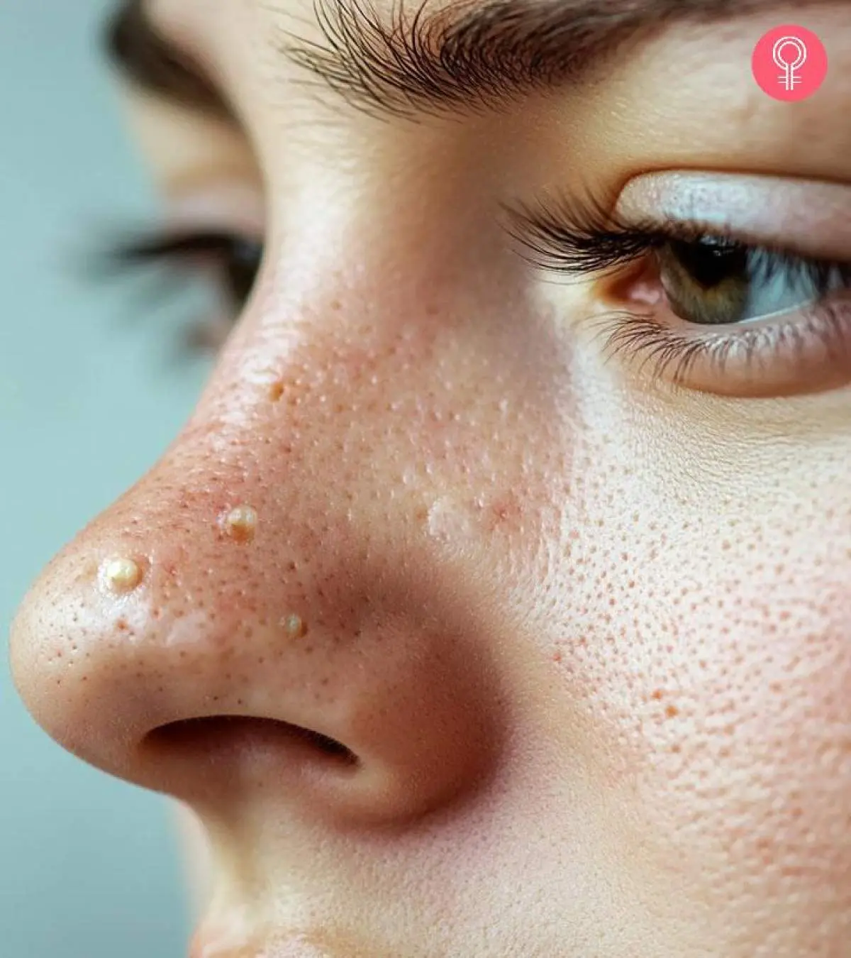 Whiteheads On Nose: 5 Prevention Tips & Treatment Options