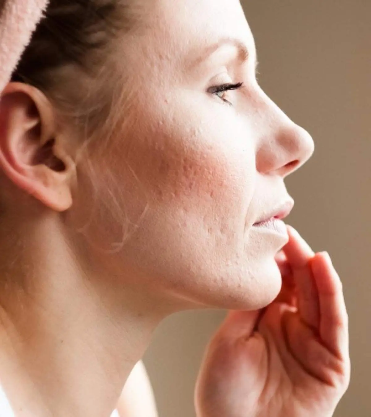 Pitted Acne Scars: 7 Effective Treatments To Smooth Skin
