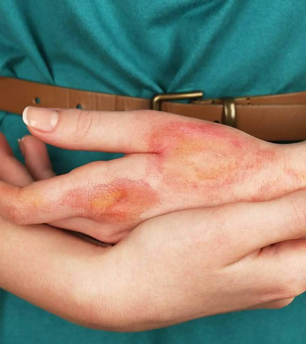 Ice Burn: Causes, Symptoms & 11 Home Treatment Tips
