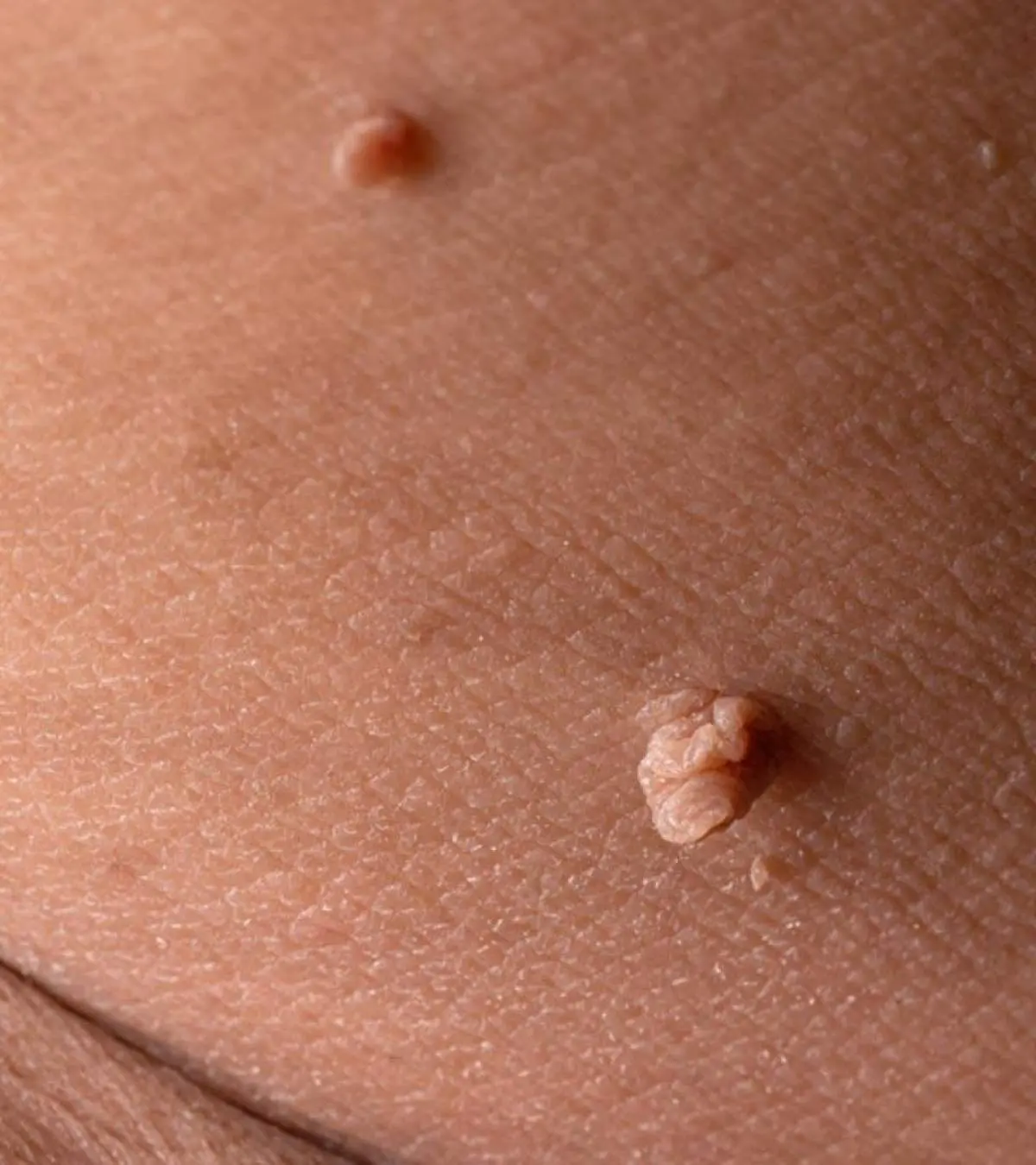 Genital Skin Tags 4 Safe Removal And Prevention Tips