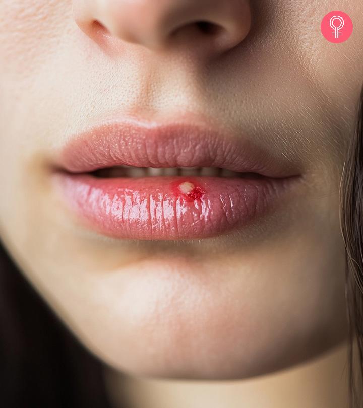 White Bumps On Lips: Types, Causes, Symptoms, & Home Remedies