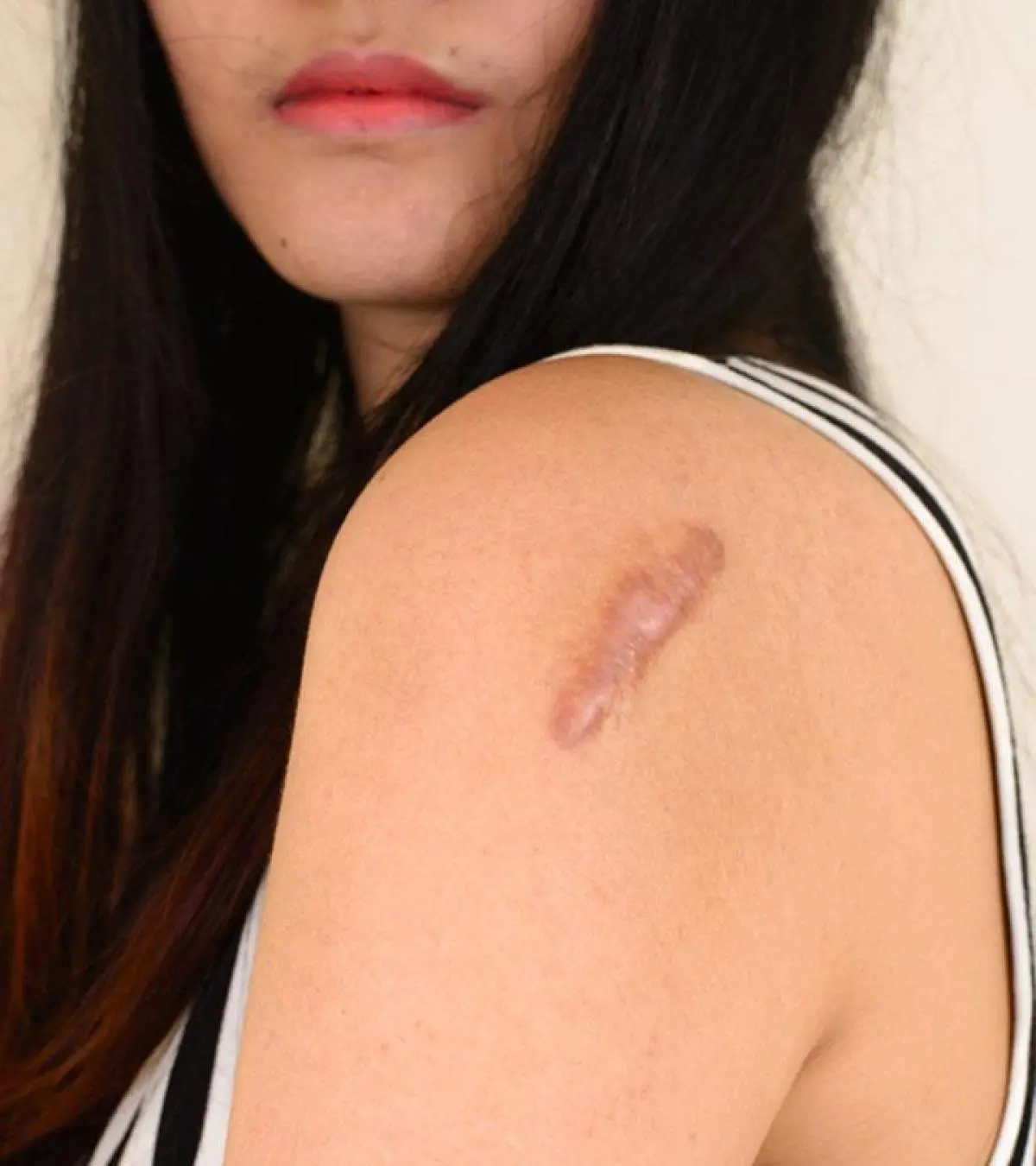 Lesions On Skin Skin Lesions: Pictures, Treatments, And Causes