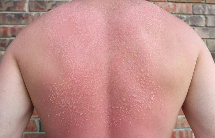 Sunburn Vs. Sun Poisoning: Symptoms, Remedies, & Prevention