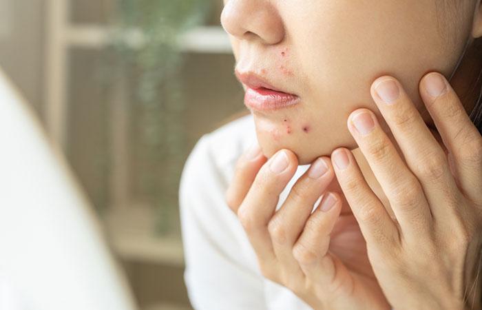 How To Get Rid Of Pimple On Lip: Remedies & Prevention