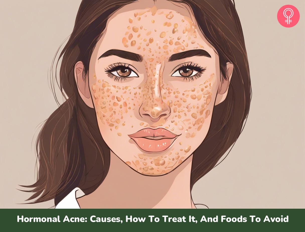 Hormonal Acne: Causes, How To Treat It, And Foods To Avoid