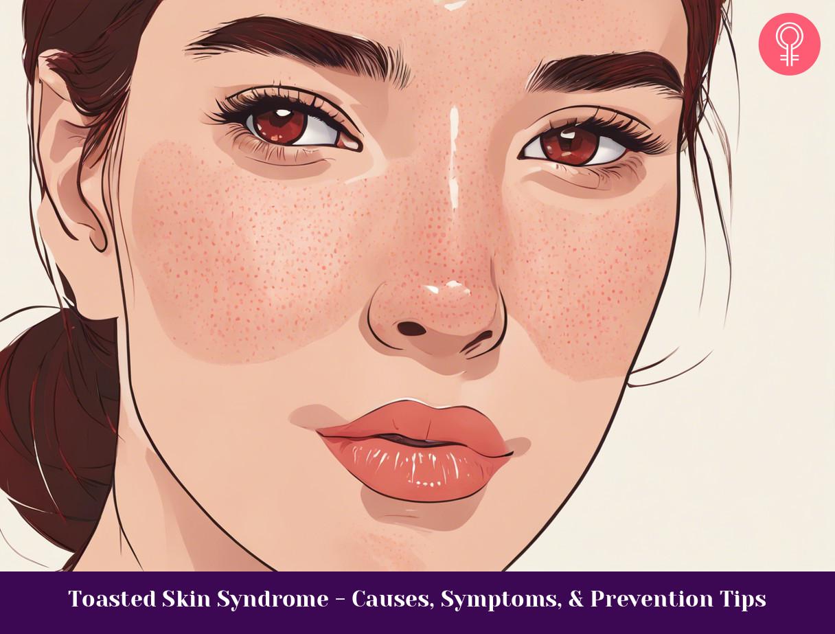 Toasted Skin Syndrome - Causes, Symptoms, & Prevention Tips